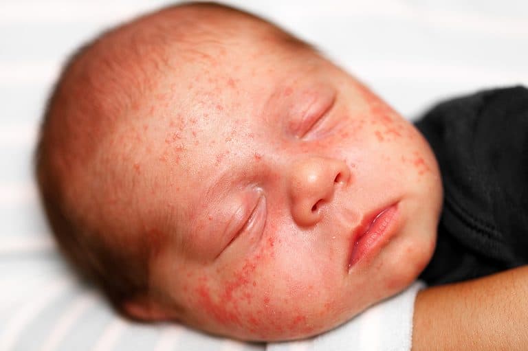 How Long Does Baby Acne Last?
