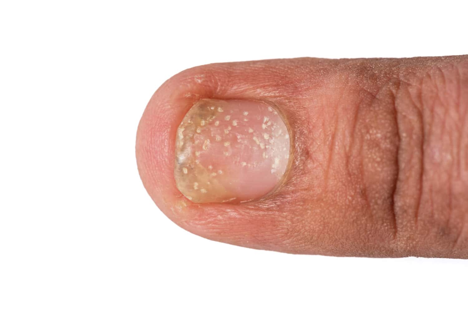 Nail Health Chart: How To Identify Problems