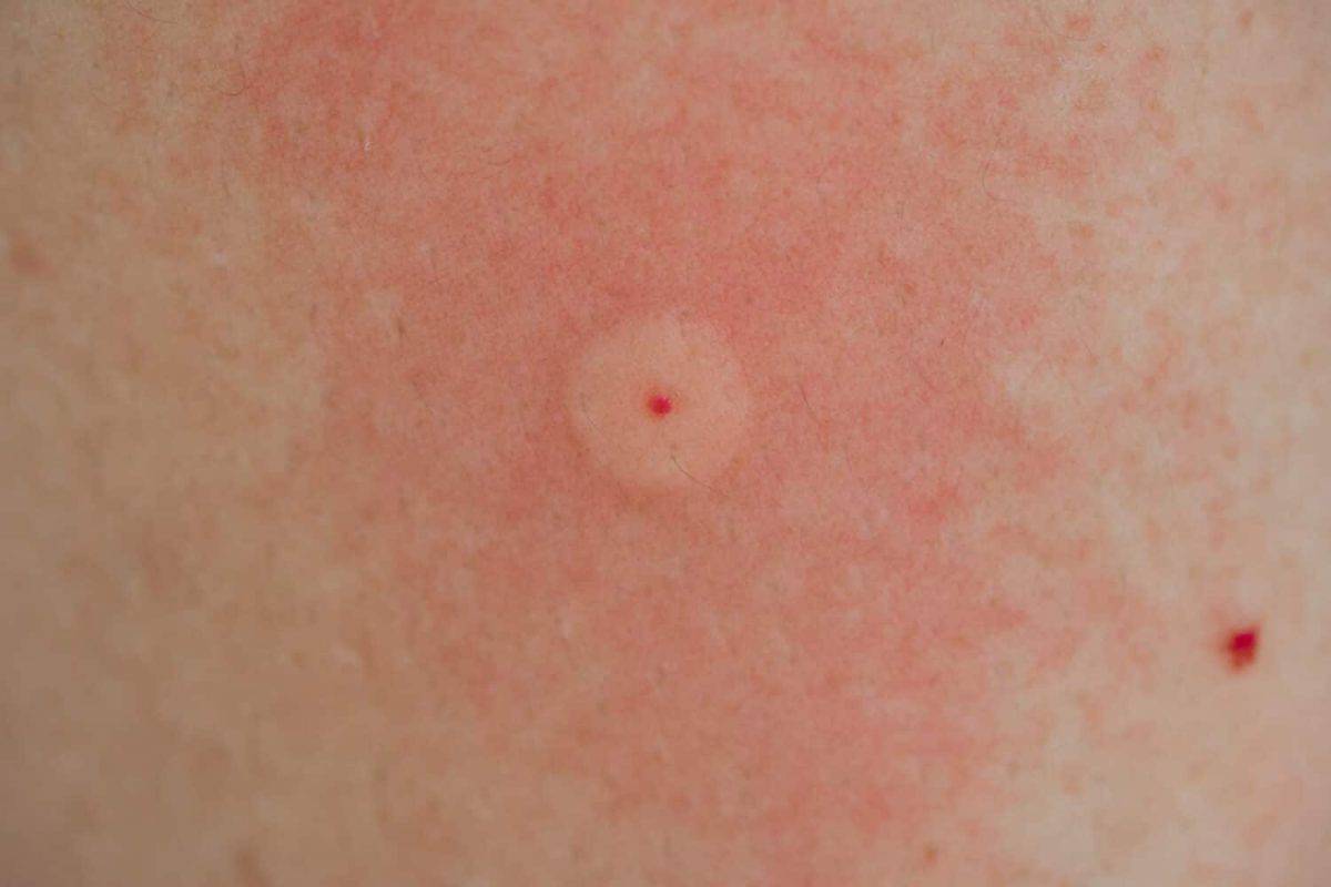 The Best Remedies for Chigger Bites