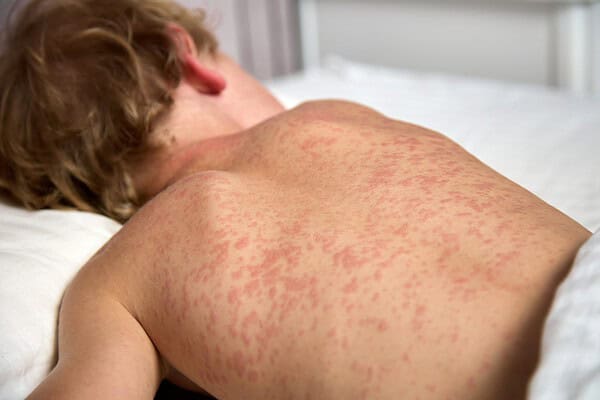 9 Childhood Diseases Boomers Remember That Are No Longer an Issue